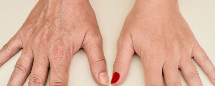 What Is PRP Hand Rejuvenation? - Akt in Motion