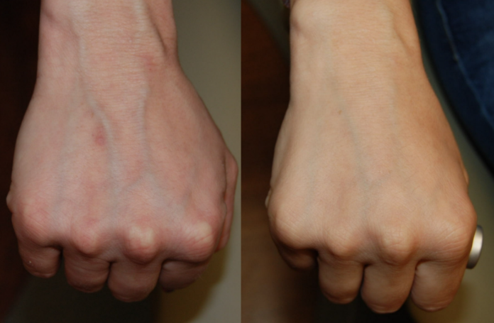 What Is PRP Hand Rejuvenation? - Akt in Motion