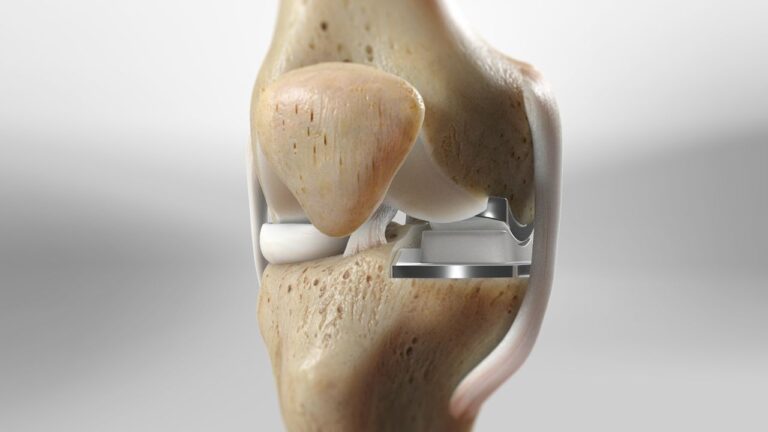 Knee Replacement Recovery Time - Akt in Motion